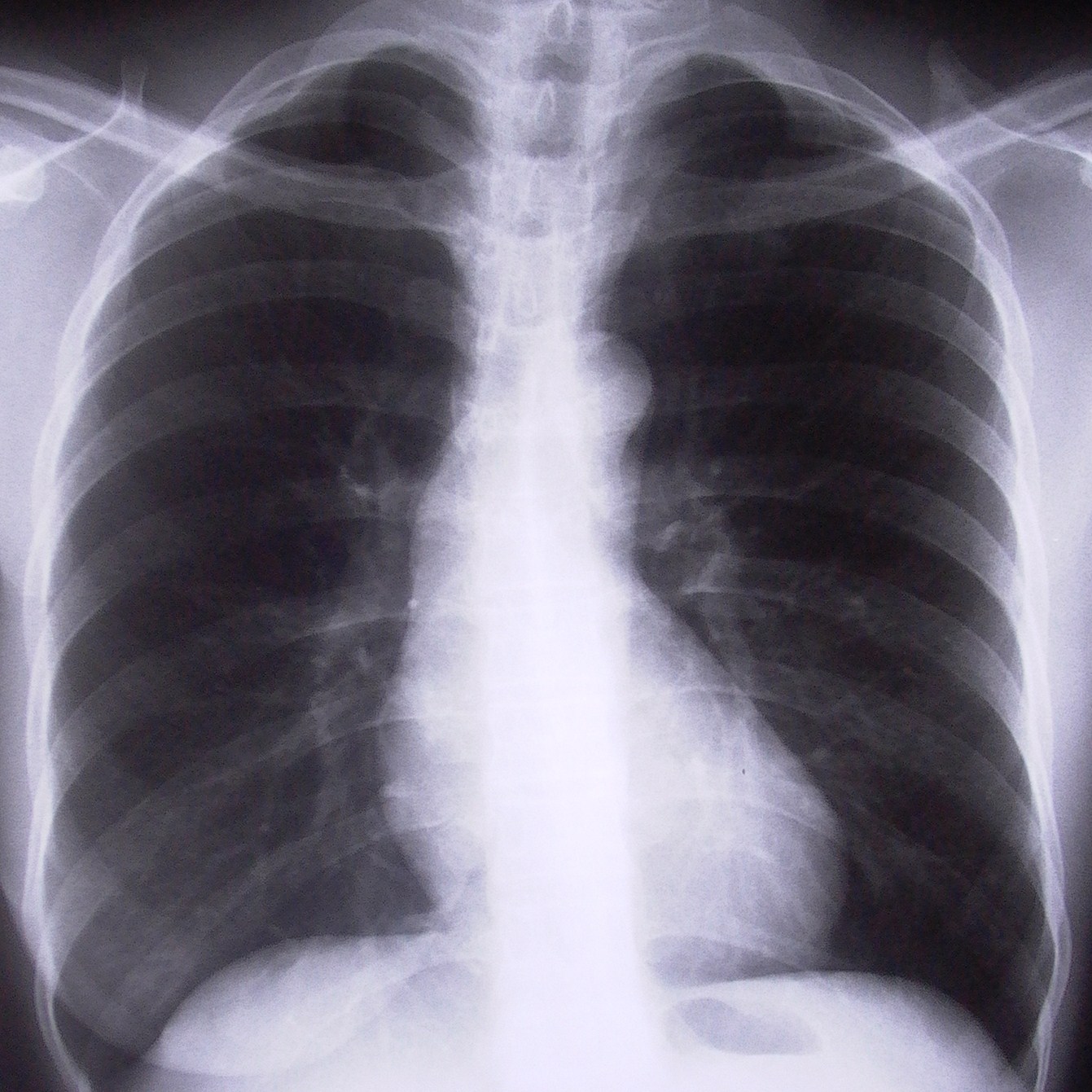 long Ontsteking - Healthylives.nl